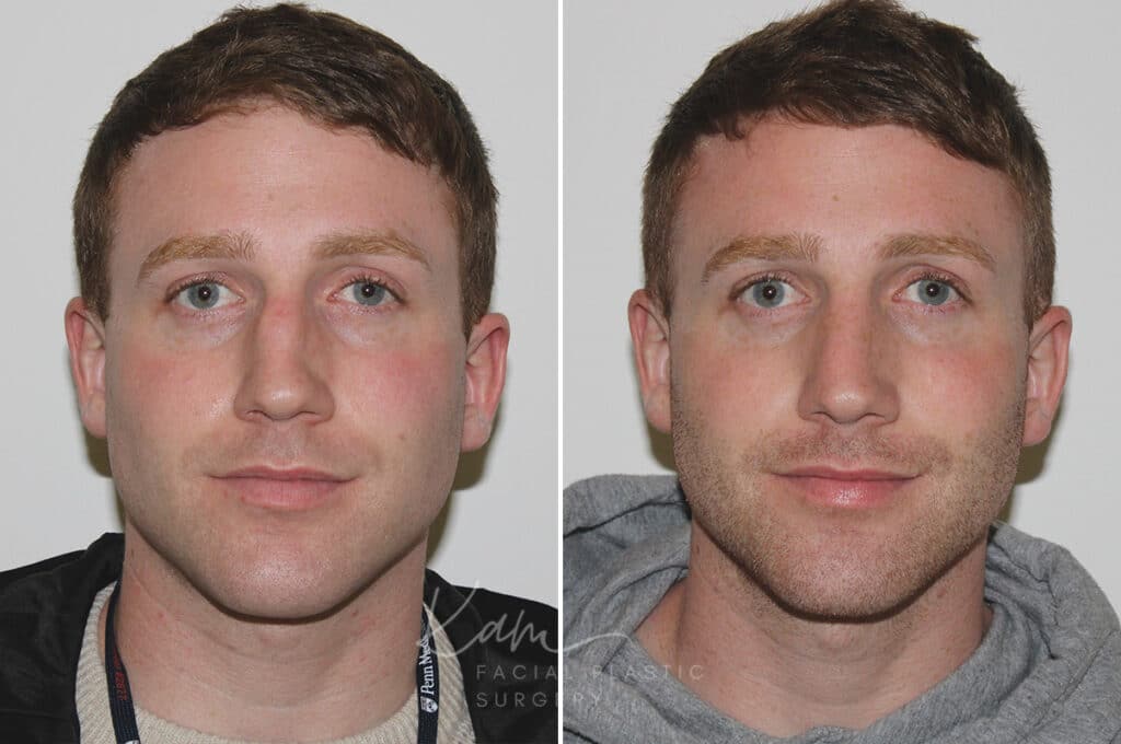 Causes of Nasal Obstruction and How Surgery Helps | New Jersey