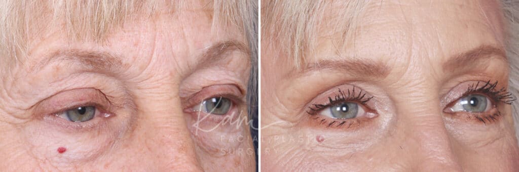 Get Rid of Under Eye Bags with Blepharoplasty | New Jersey