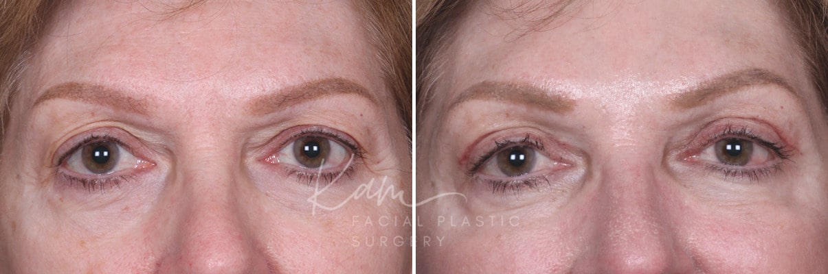 Is Blepharoplasty Worth It? Top Benefits, Risks & More