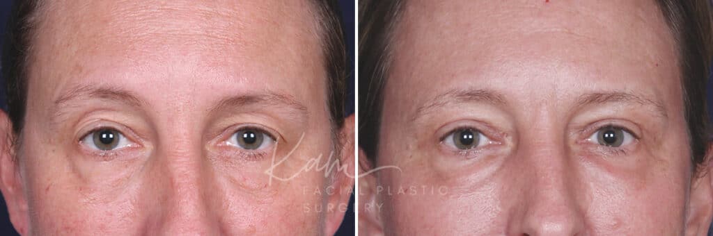 Minimize Scars Post-Eyelid Surgery | New Jersey