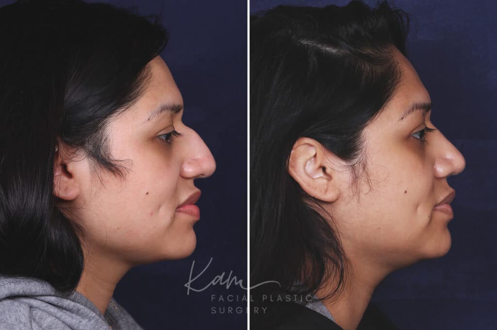 Preventing Visible Scars Before and After Rhinoplasty | New Jersey