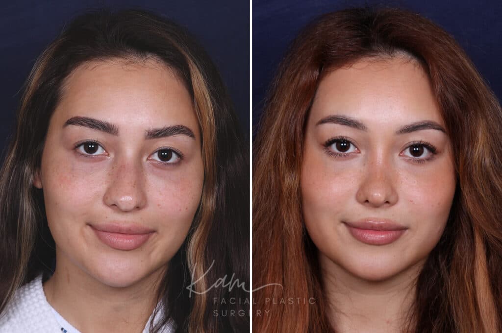 Closed and Open Rhinoplasty Differences | New Jersey