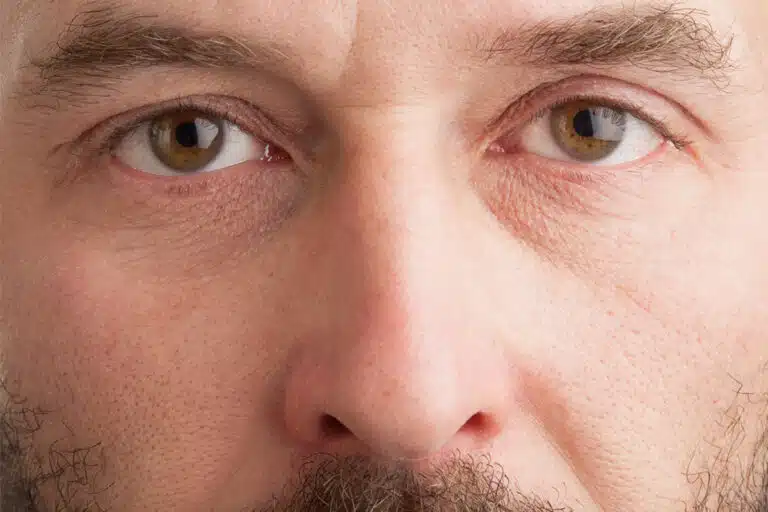 Detect and Treat Early Stage Rhinophyma | New Jersey