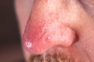 Detect and Treat Early Stage Rhinophyma | New Jersey