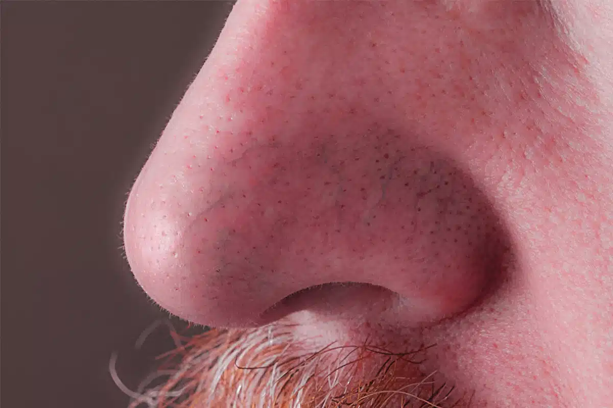 Understanding Rhinophyma Surgery | New Jersey