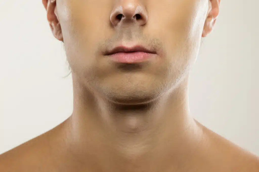 Buccal Fat Removal for Men - What can you expect | New Jersey