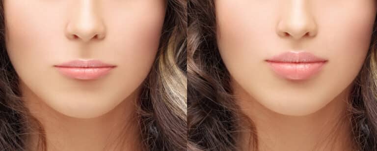 Achieve a Youthful Look: The Remarkable Impact of Lip Lift Surgery