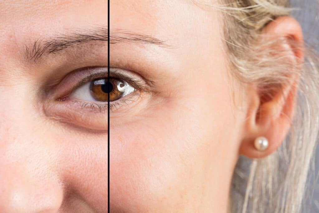 Comparing Tear Trough Filler and Blepharoplasty | New Jersey