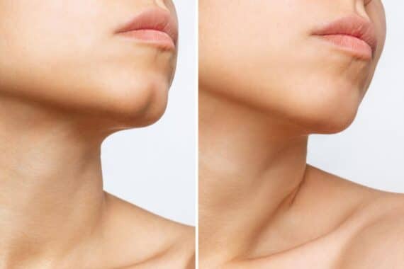 How to Get Rid of Cleft Chin? | Kam Facial Plastic Surgery