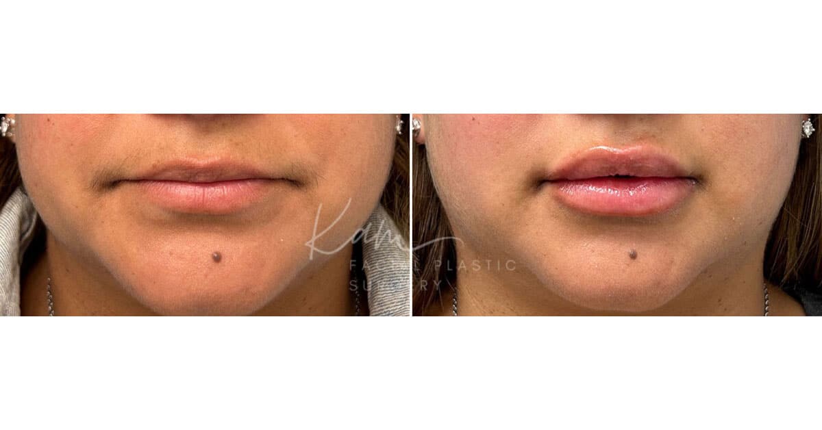 Injectable Treatments in New Jersey | Kam Facial Plastic Surgery