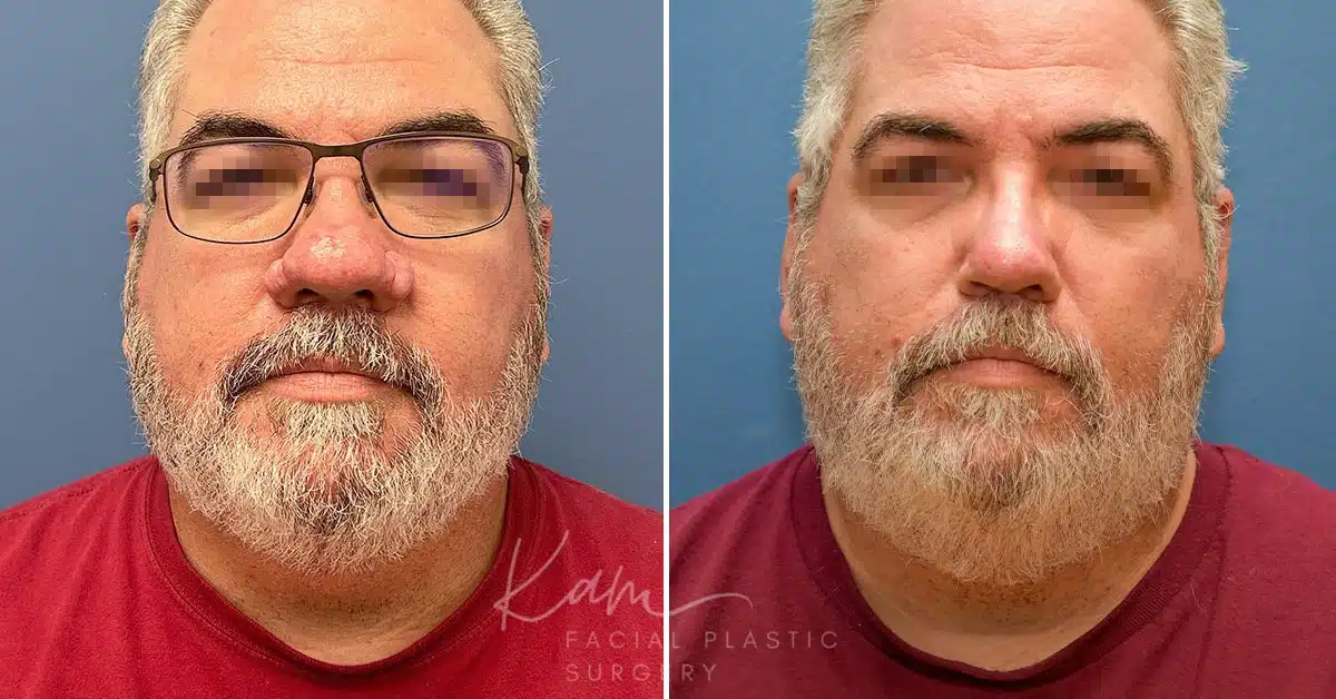 Rhinophyma Treatment New Jersey | Kam Facial Plastic Surgery