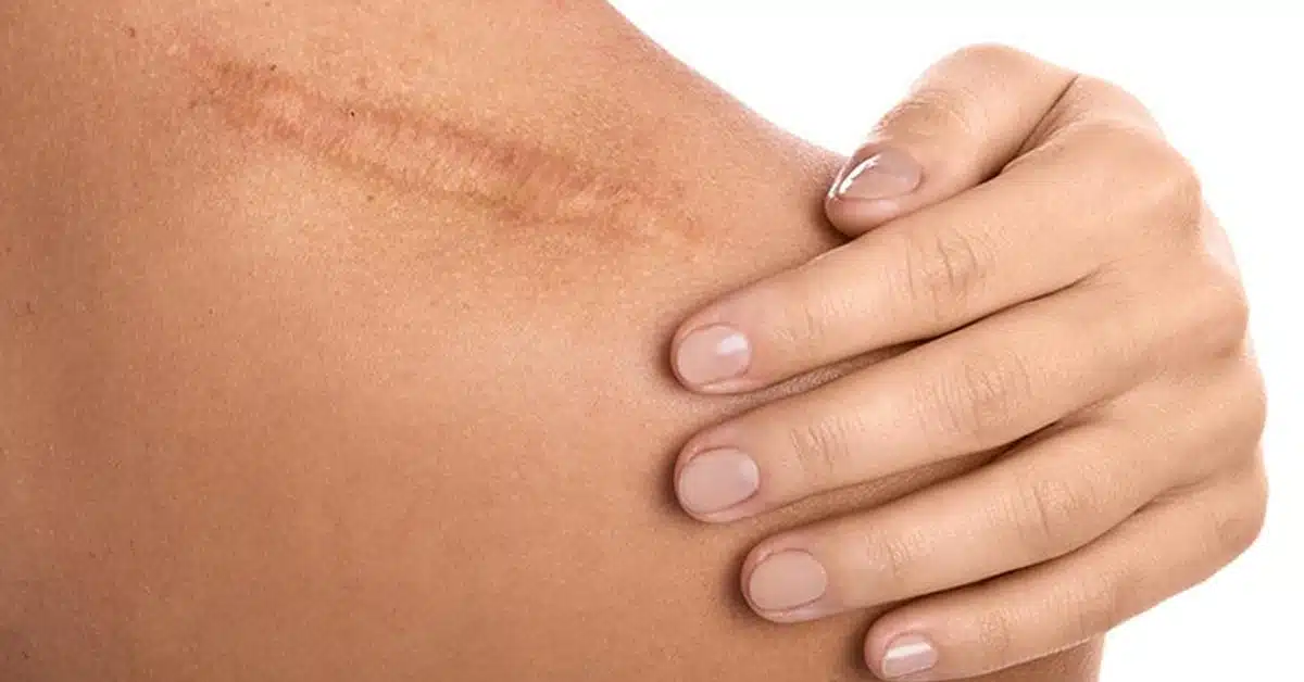 Scar Revision in New Jersey | Kam Facial Plastic Surgery