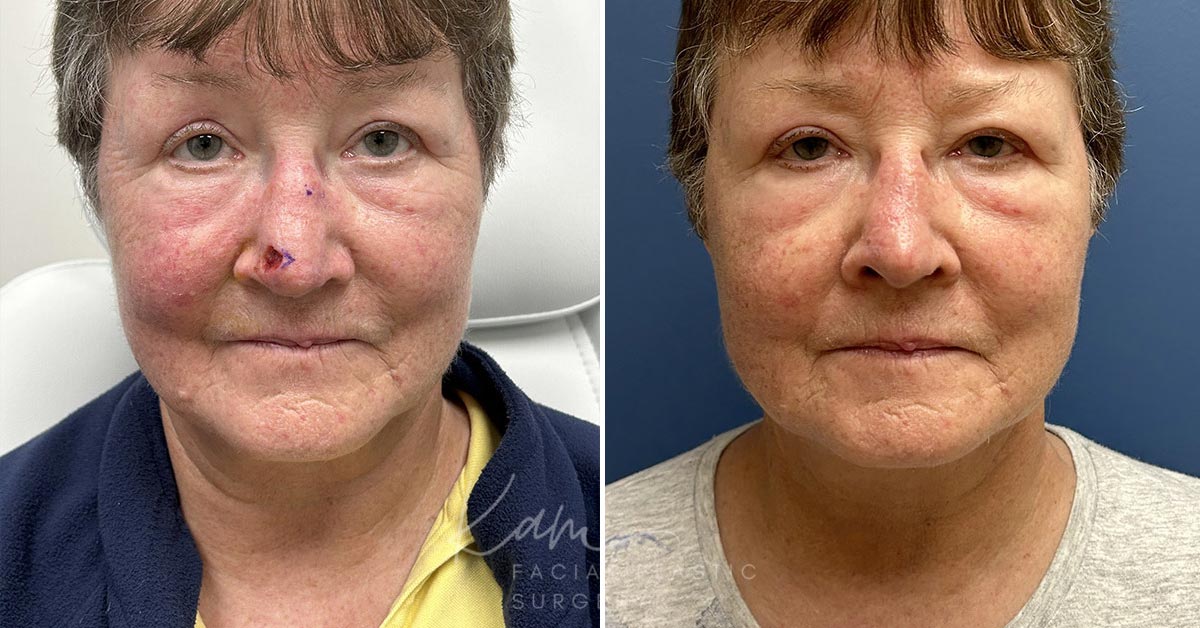 Skin Cancer Reconstruction in New Jersey | Dr. Joanna Kam