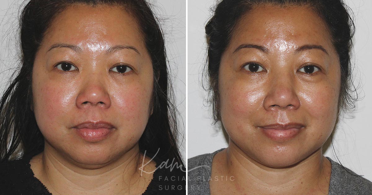 Submental Liposuction New Jersey | Kam Facial Plastic Surgery