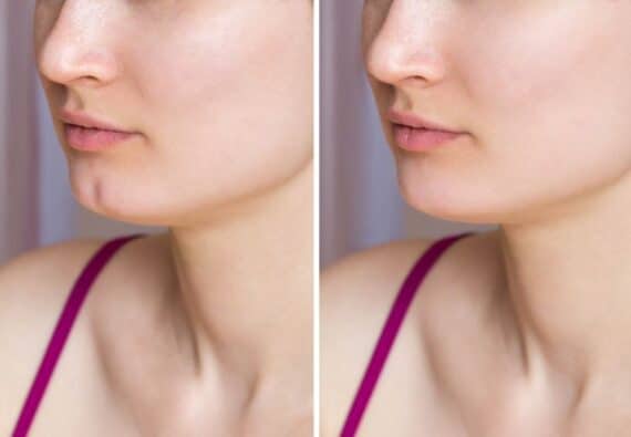 How to Get Rid of Cleft Chin? | Kam Facial Plastic Surgery