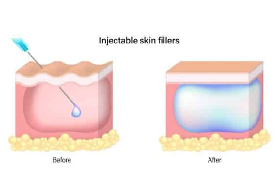 Discover Dermal Fillers for Cleft Chin Smoothing | Dr. Kam
